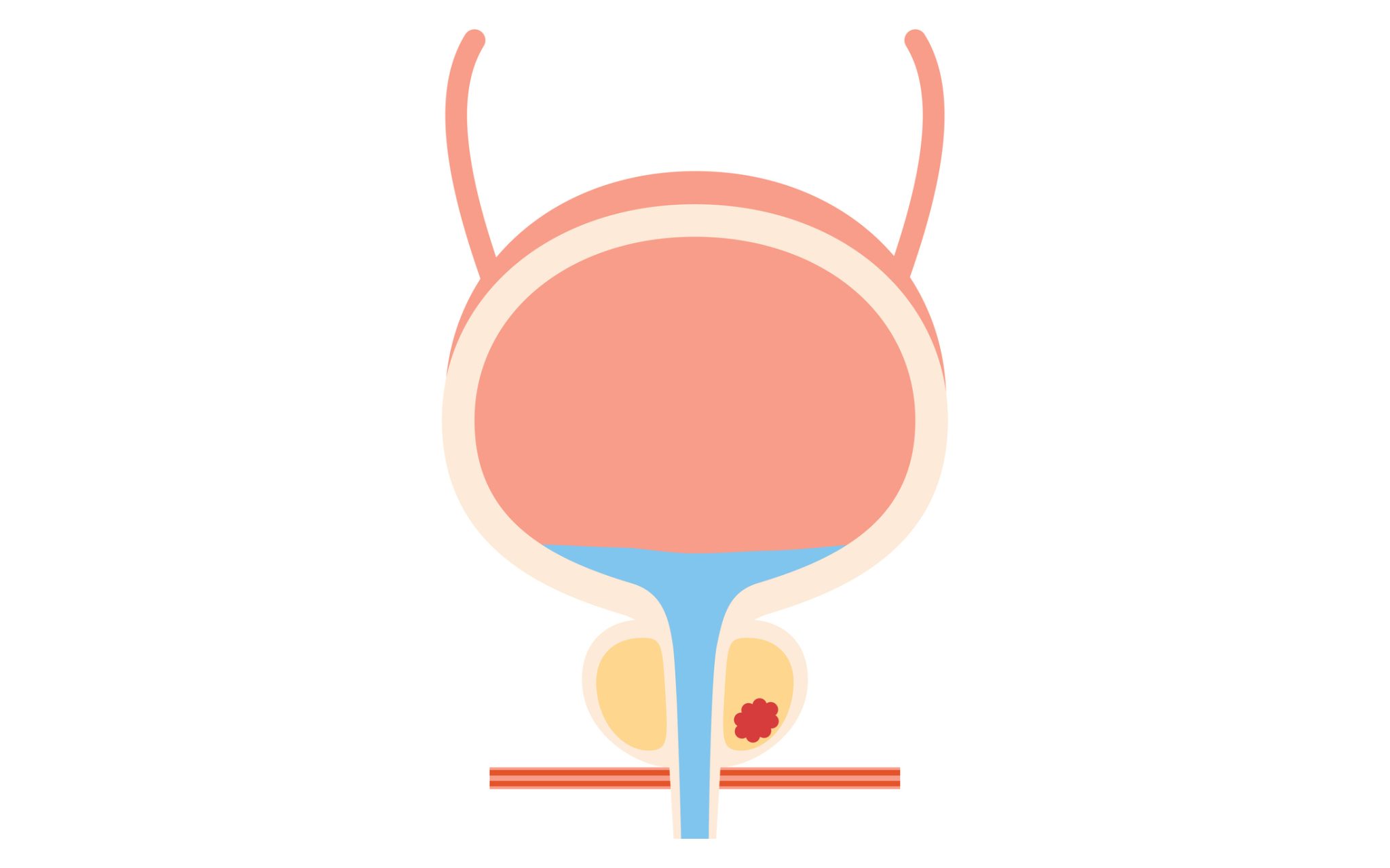 RESEARCH REVIEW: Fish oil and low-omega-6 diet for prostate cancer | Dr ...