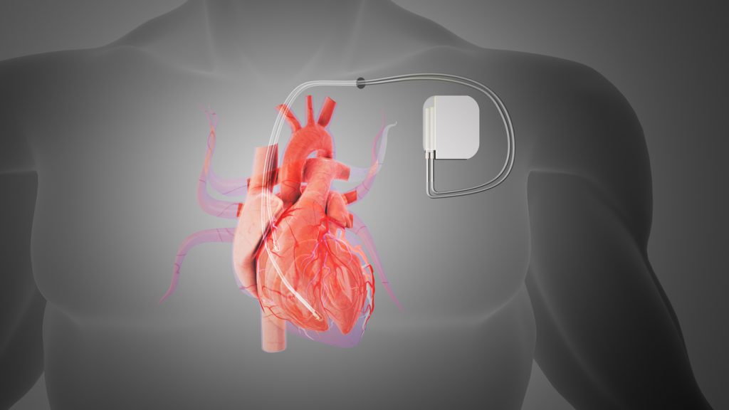 Heart with implanted pacemaker system | Dr. Ronald Hoffman
